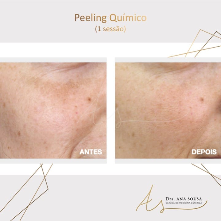 Resultados dos Tratamentos - Dra Ana Sousa - Medicina Estética no Porto